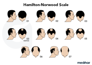 Crown Hair Transplant: Cost, Before and After and Clinics