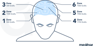 7 Hamilton-Norwood Scale Types (+Hair Transplant Cost)